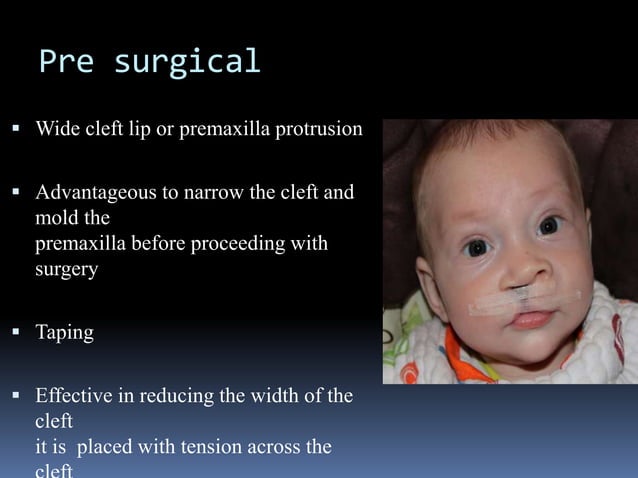 Cleft lip and Cleft palate embryology, features, and management | PPTX