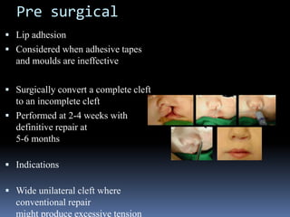 Cleft lip and Cleft palate embryology, features, and management | PPTX