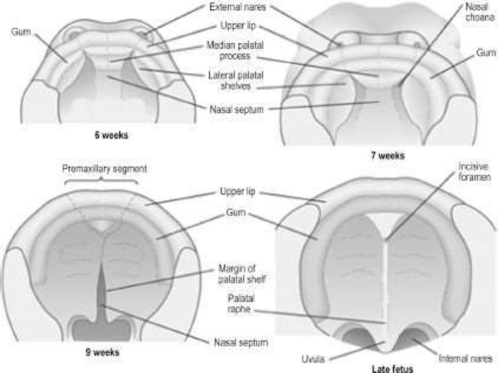 Cleft lip and Cleft palate embryology, features, and management