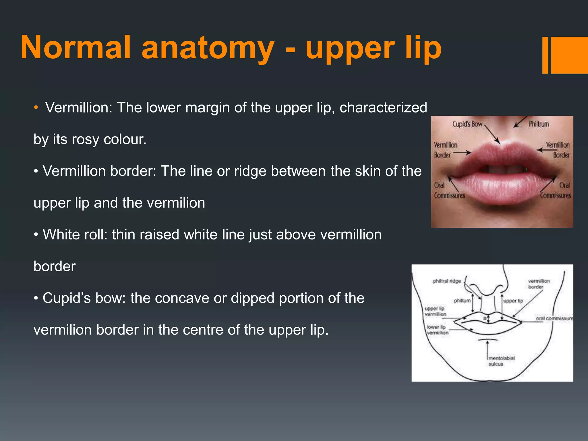 Cleft lip | PPTX