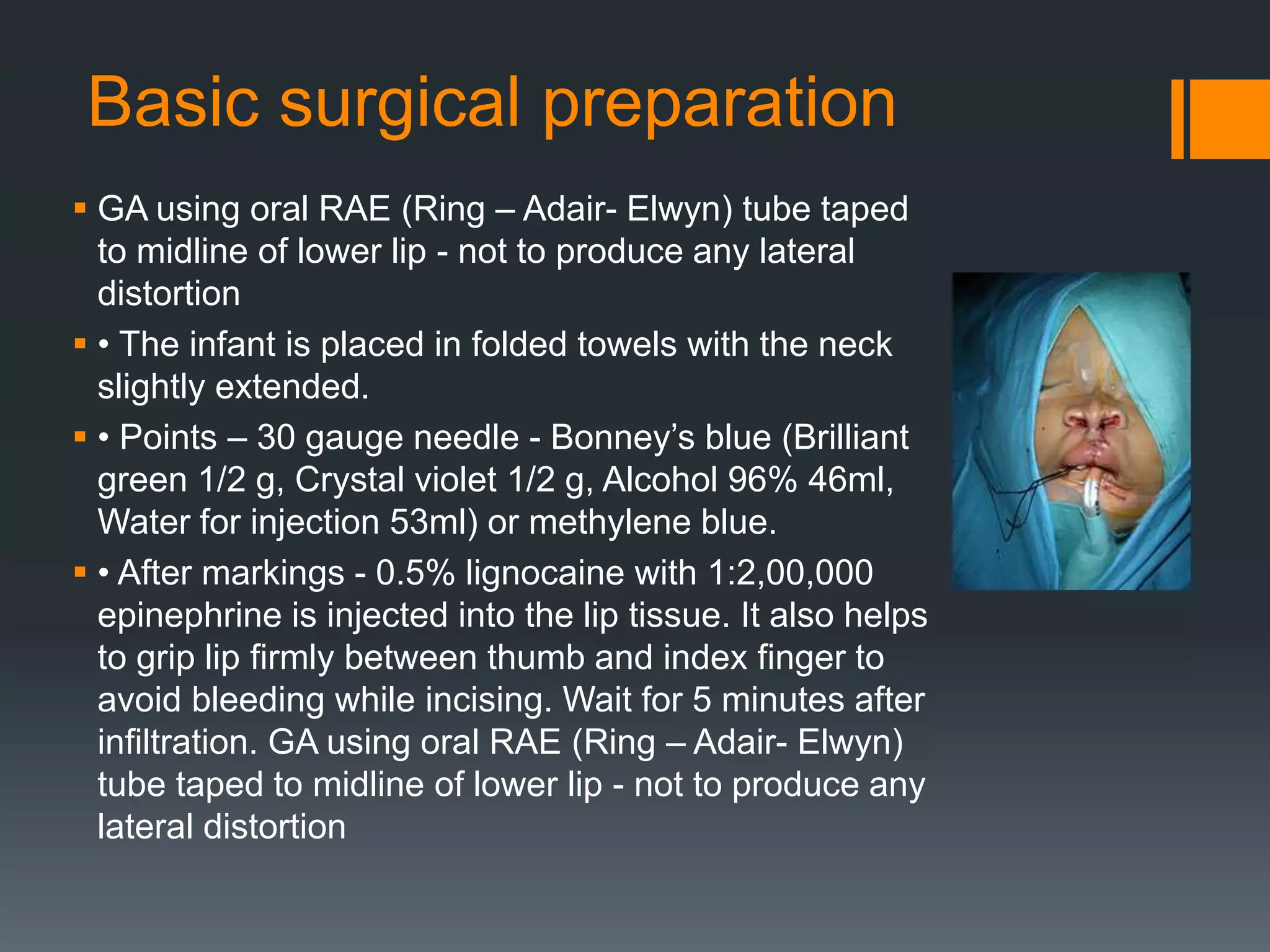 Cleft lip | PPTX