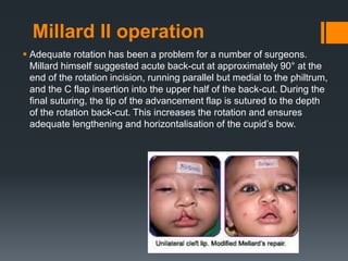 Cleft lip | PPTX
