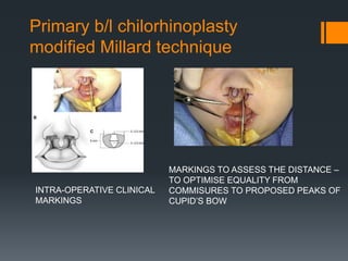 Cleft lip | PPTX
