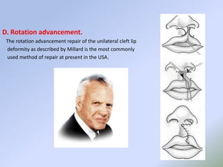 Clinical aspects of cleft lip repair | PPTX