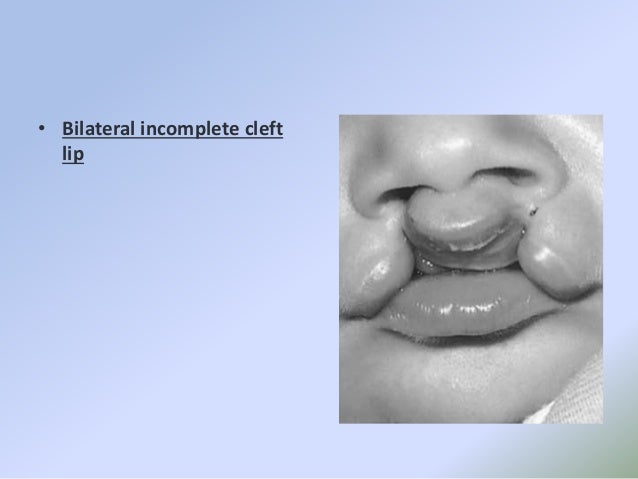 Clinical aspects of cleft lip repair