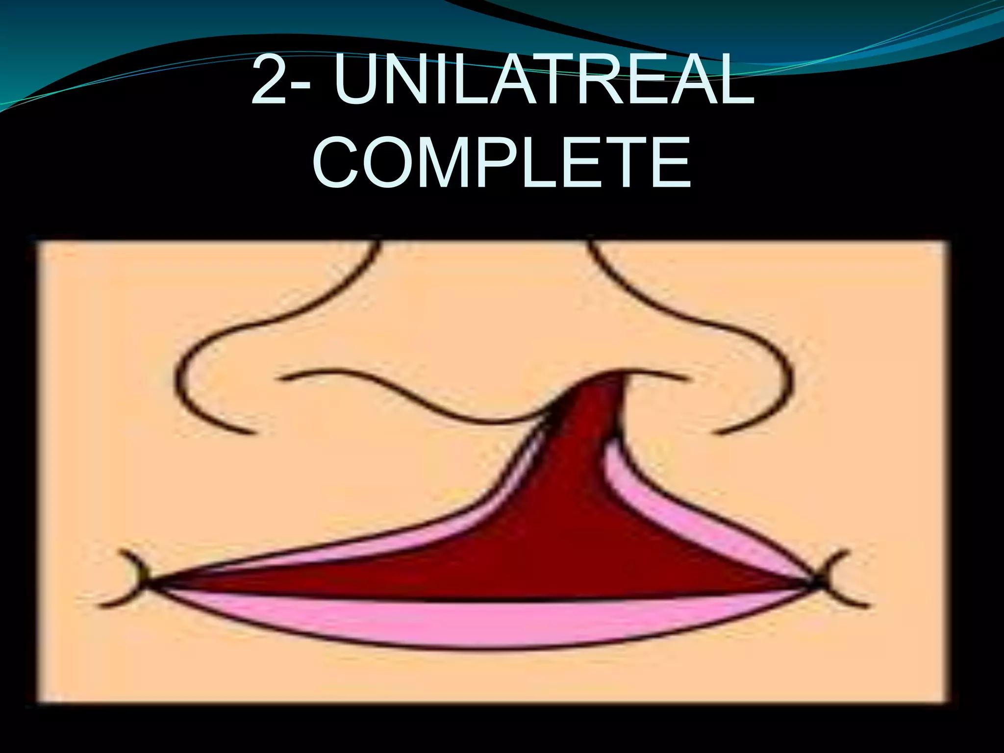 Cleft lip and Cleft palate (Pediatrics) | PPTX