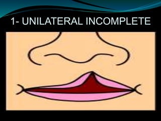 Cleft lip and Cleft palate (Pediatrics) | PPTX