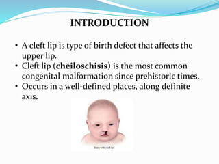Cleft lip | PPT