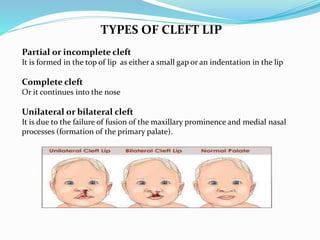 Cleft lip | PPT