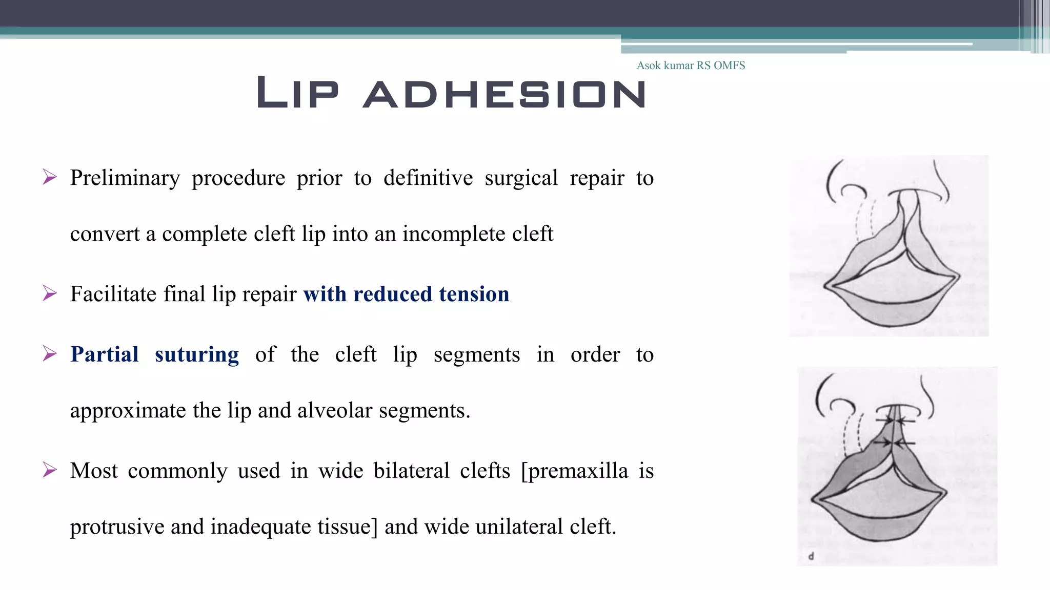 Cleft lip | PPT