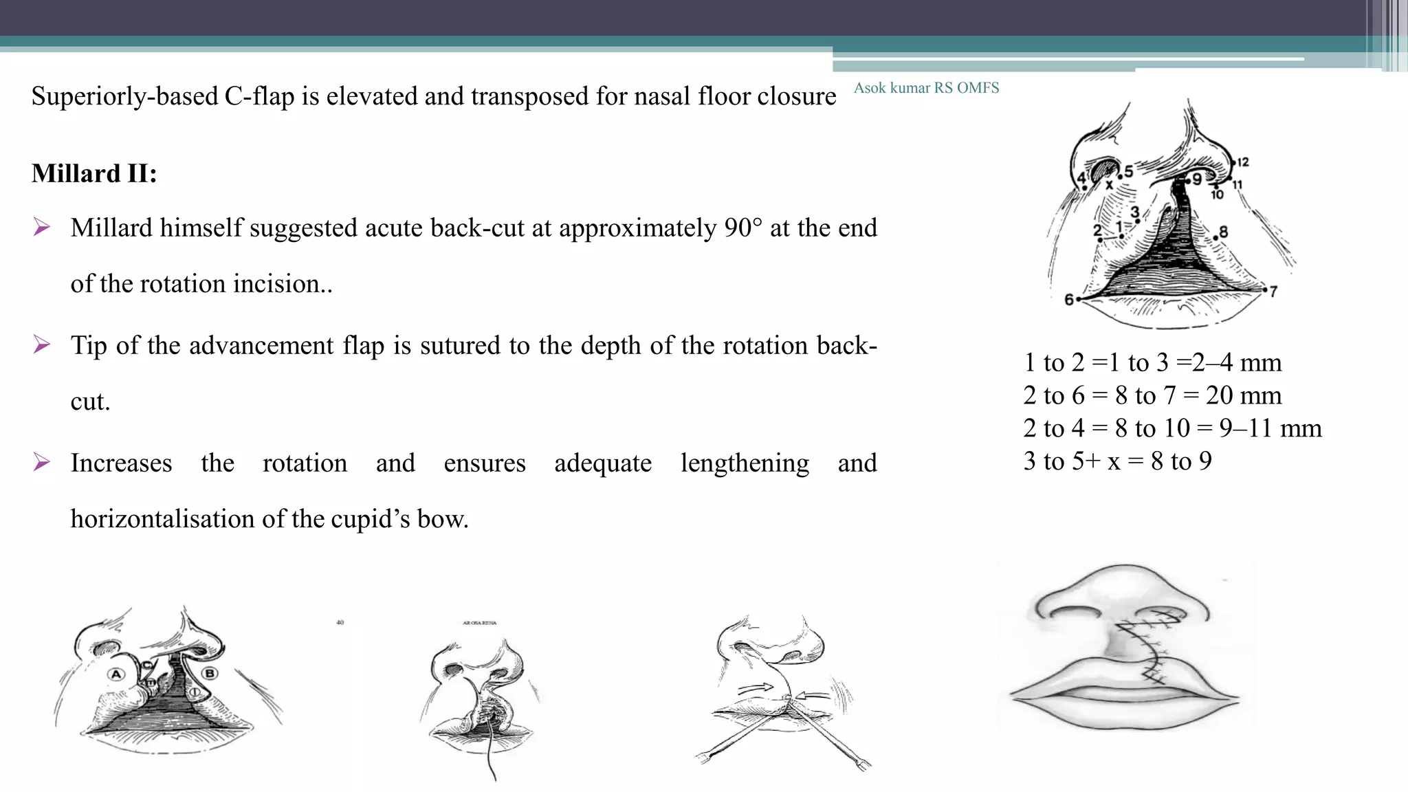 Cleft lip | PPT