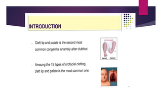 cleft lip.pdf