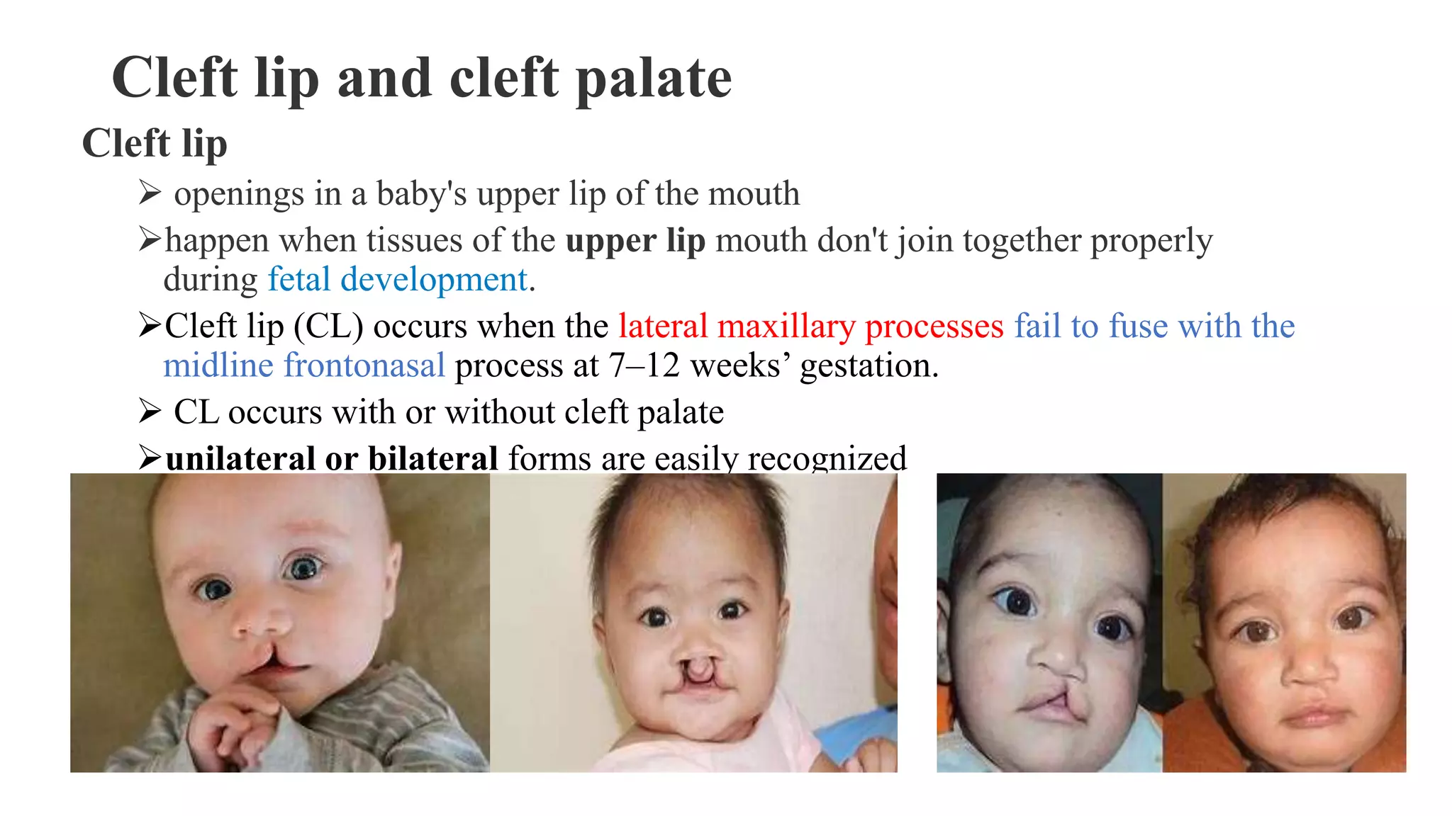 cleft lip.pptx