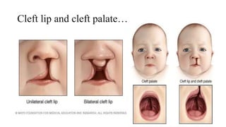 cleft lip.pptx | Pregnancy | Reproductive Health