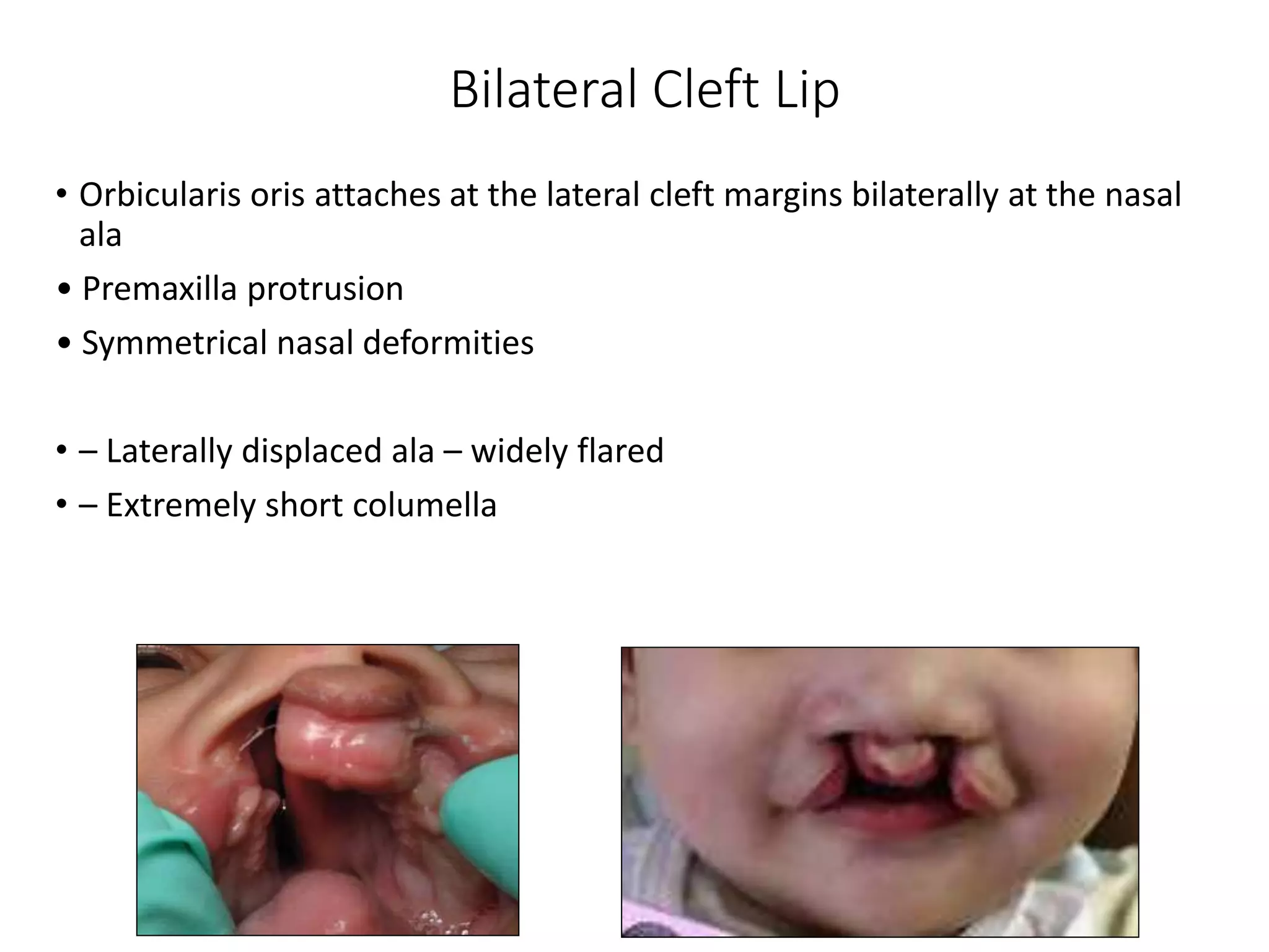 cleft lip.pptx