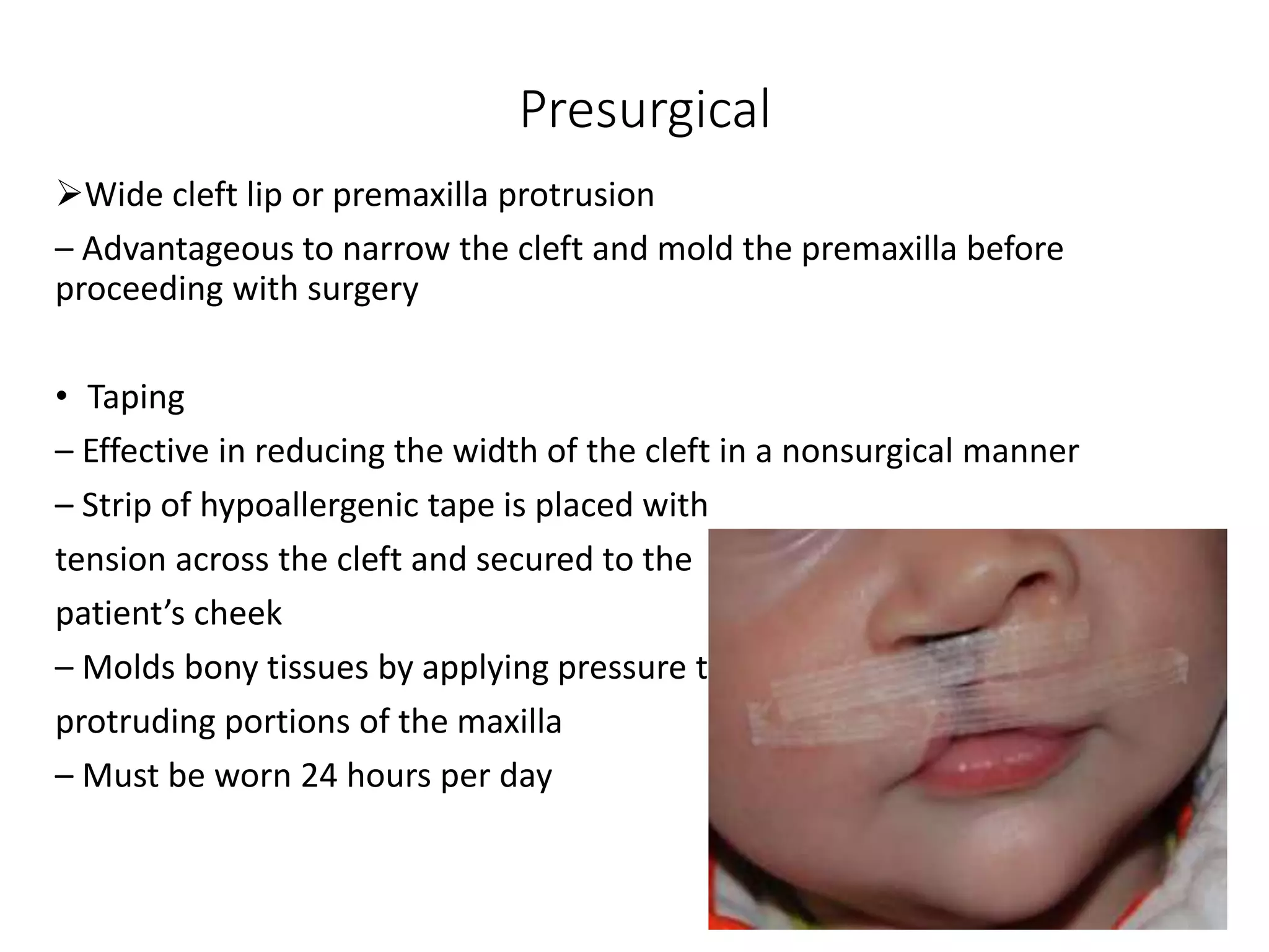 cleft lip.pptx
