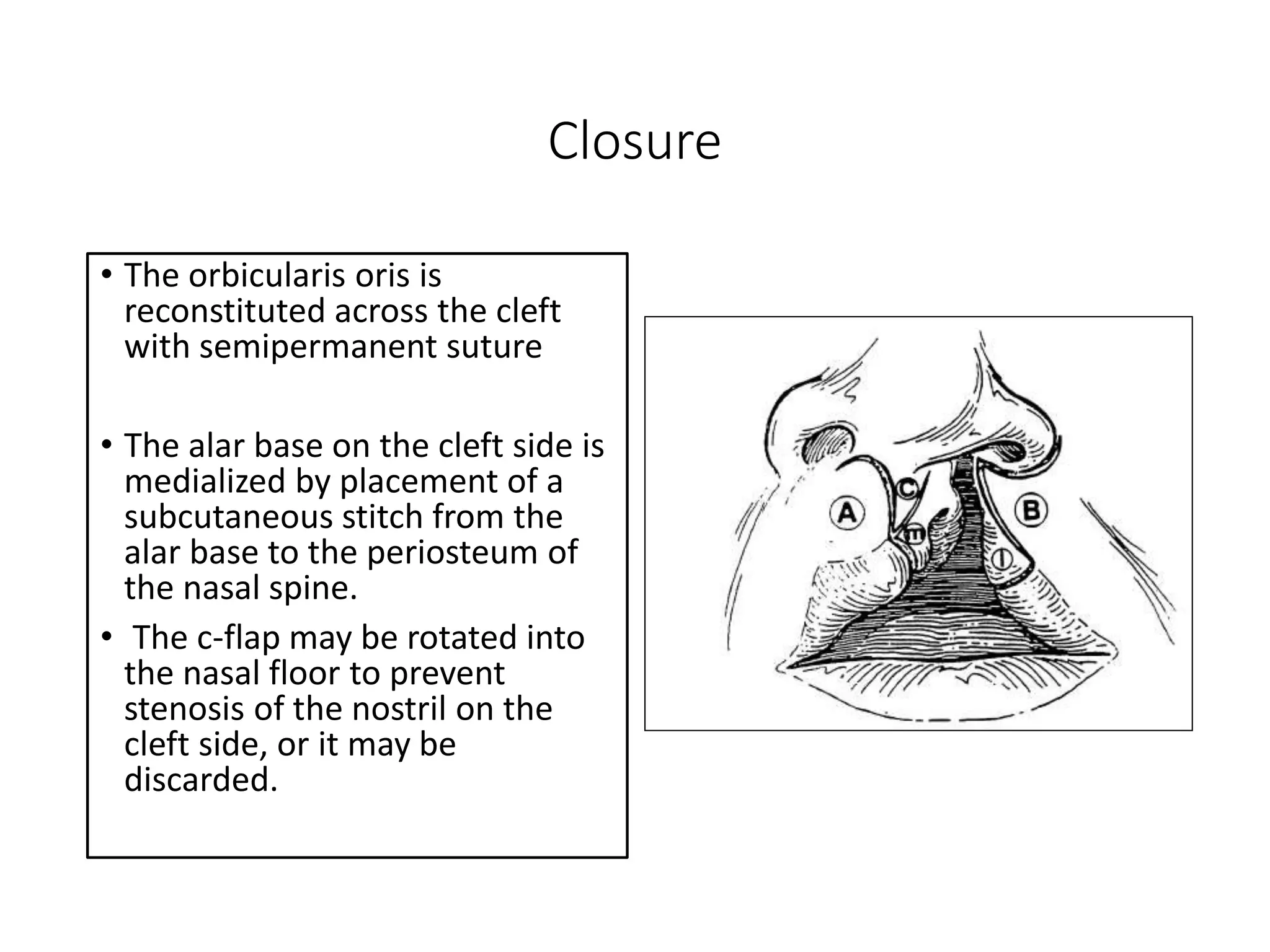cleft lip.pptx