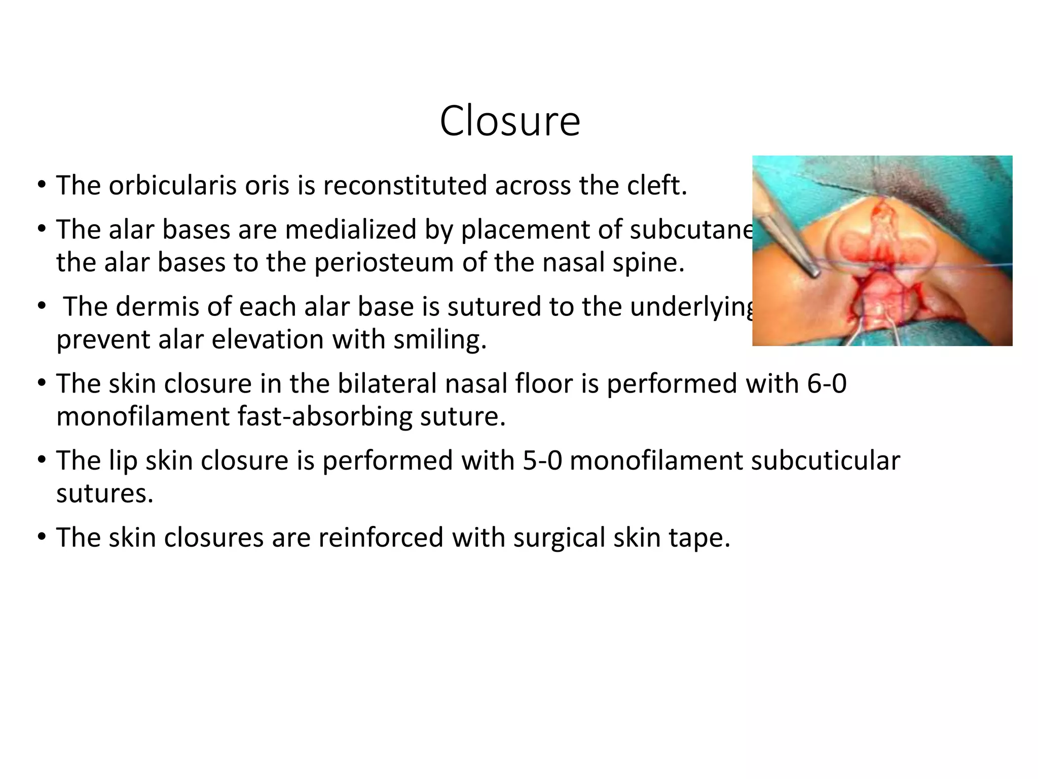 cleft lip.pptx