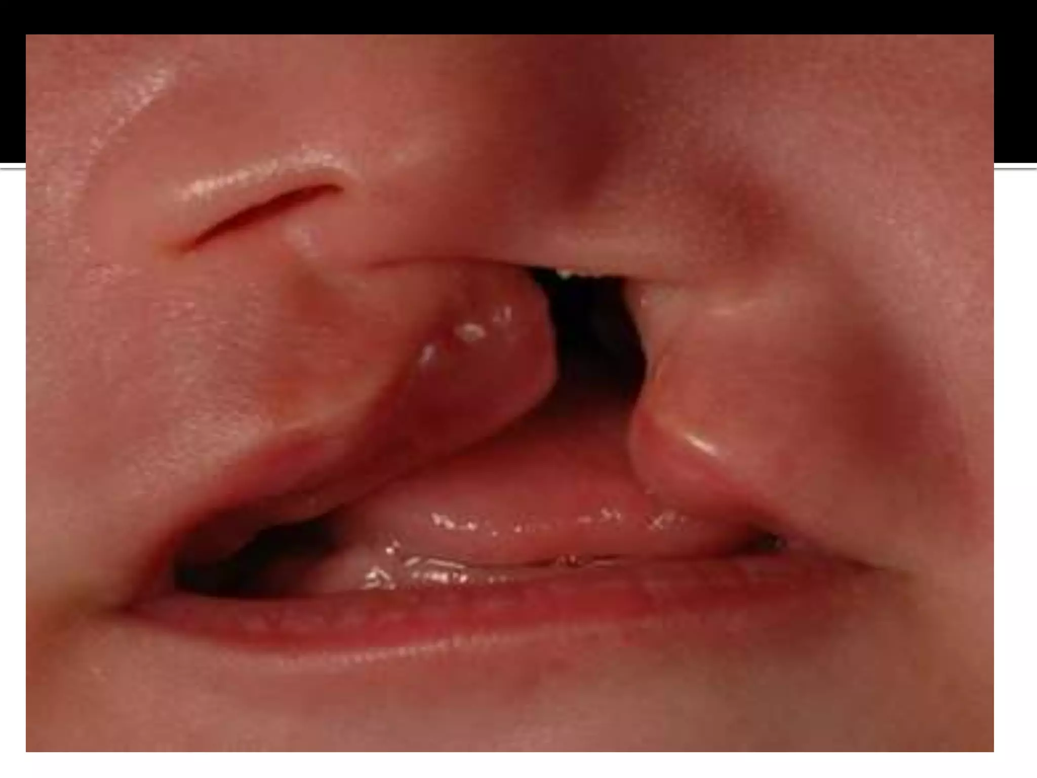 cleft lip and cleft palate.pptx