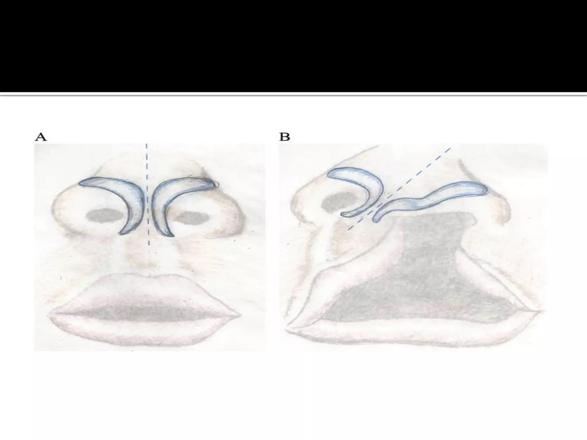 cleft lip and cleft palate.pptx