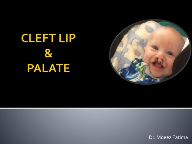 cleft lip and cleft palate.pptx