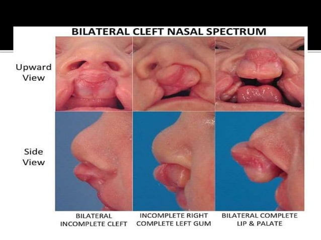 cleft lip and cleft palate.pptx