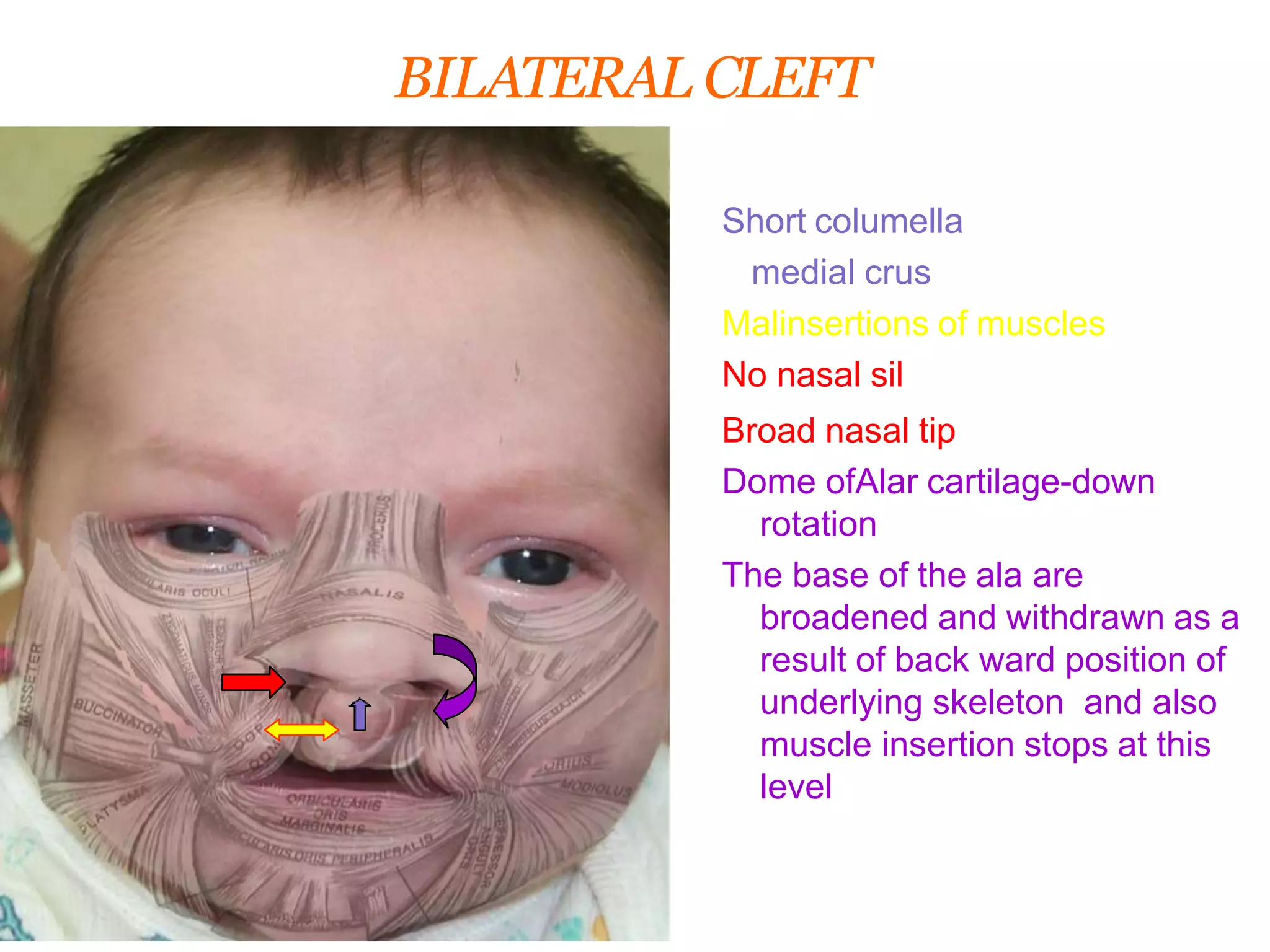 cleft lip.pptx