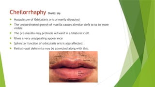 Cleft lip: Diagnosis & Management. .pptx