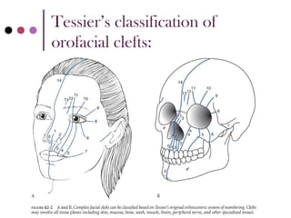 cleft lip and palate and its management.pptx
