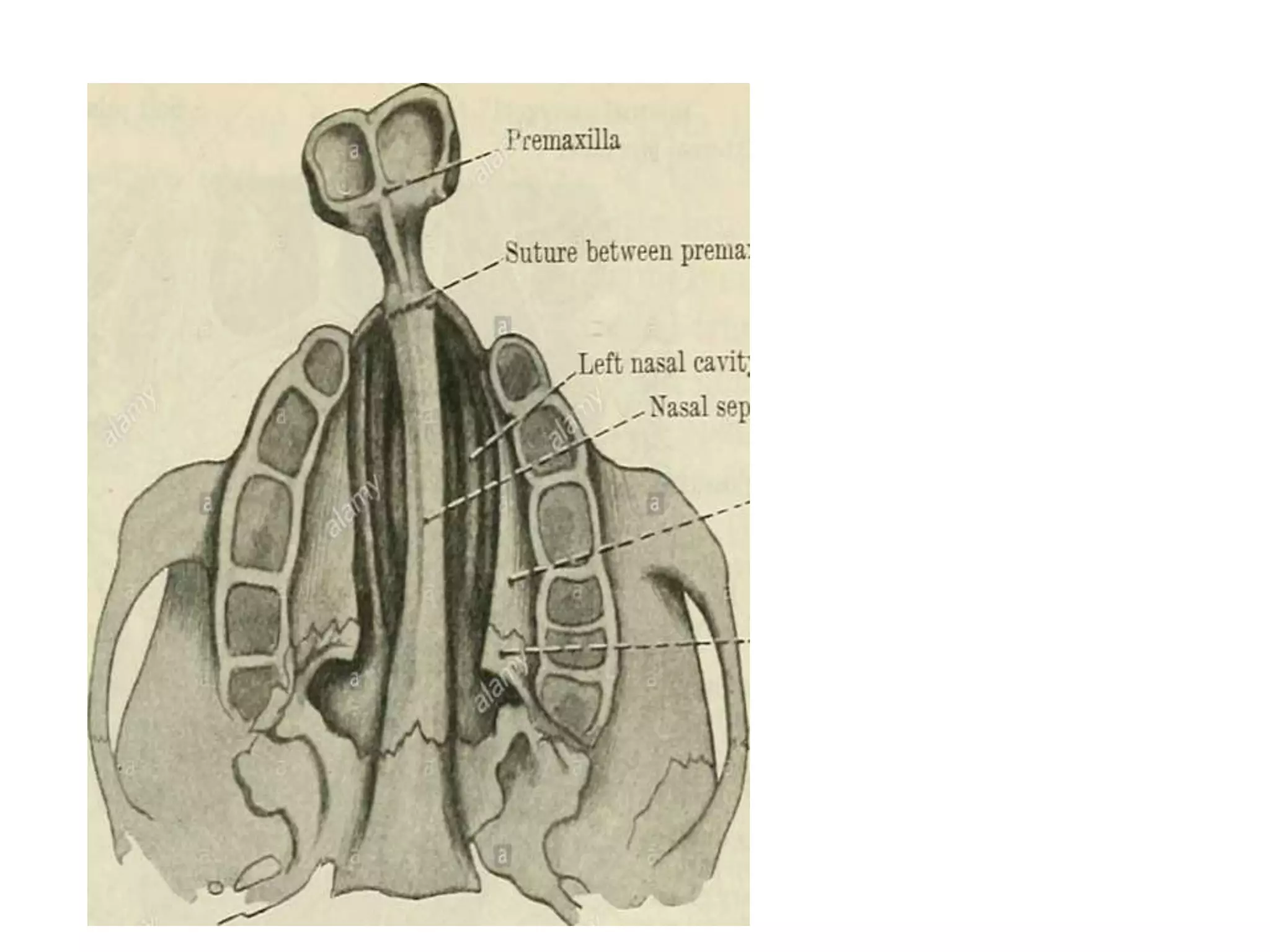 Cleft lip bilateral | PPTX