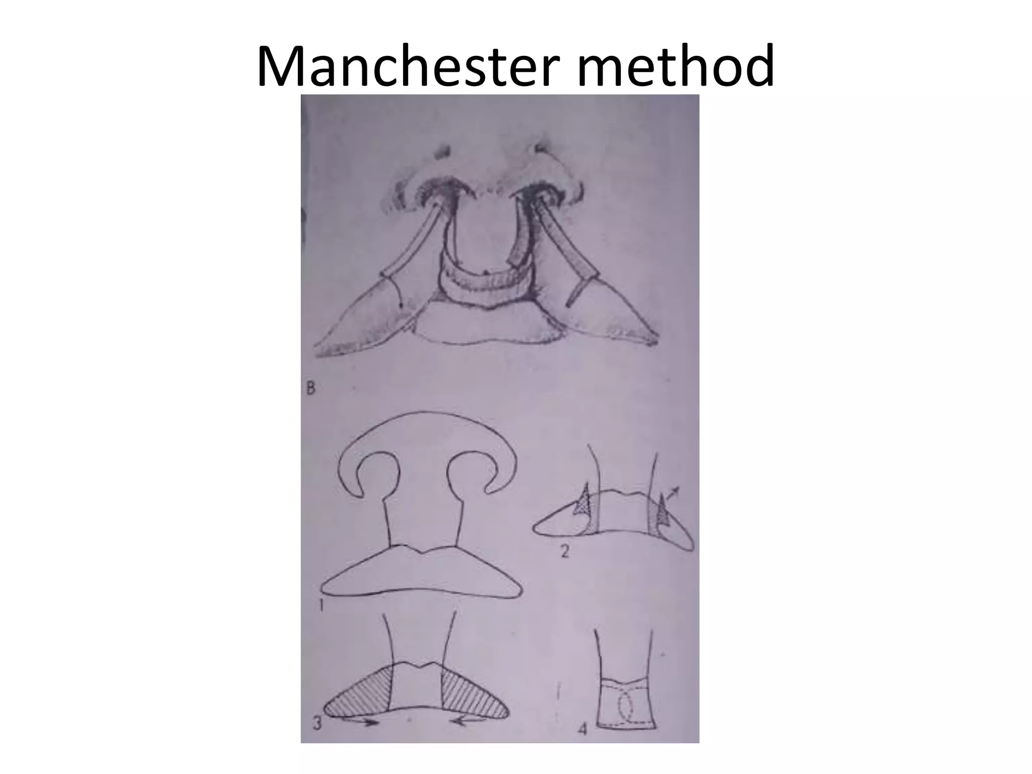 Cleft lip bilateral | PPTX