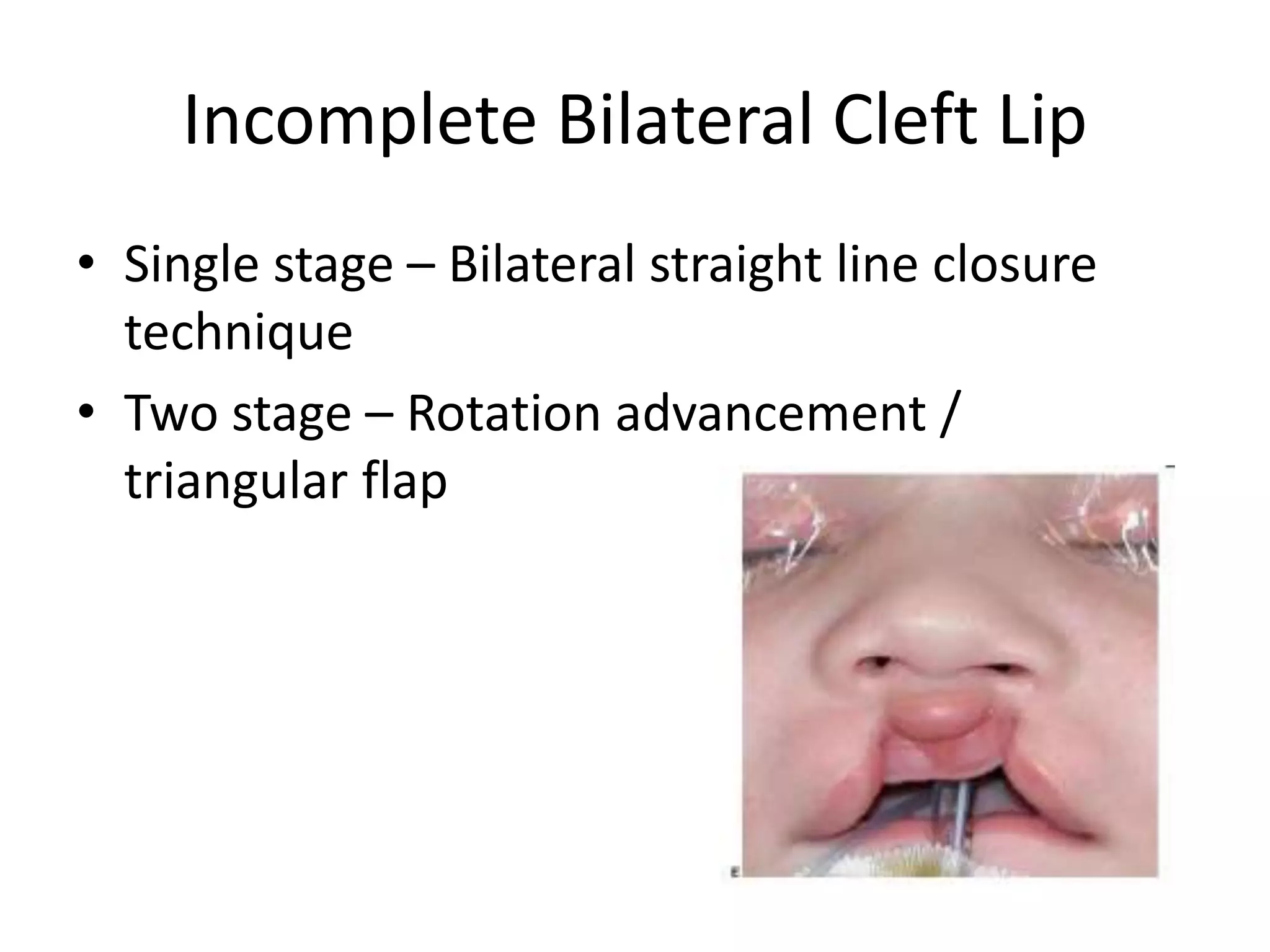 Cleft lip bilateral | PPTX