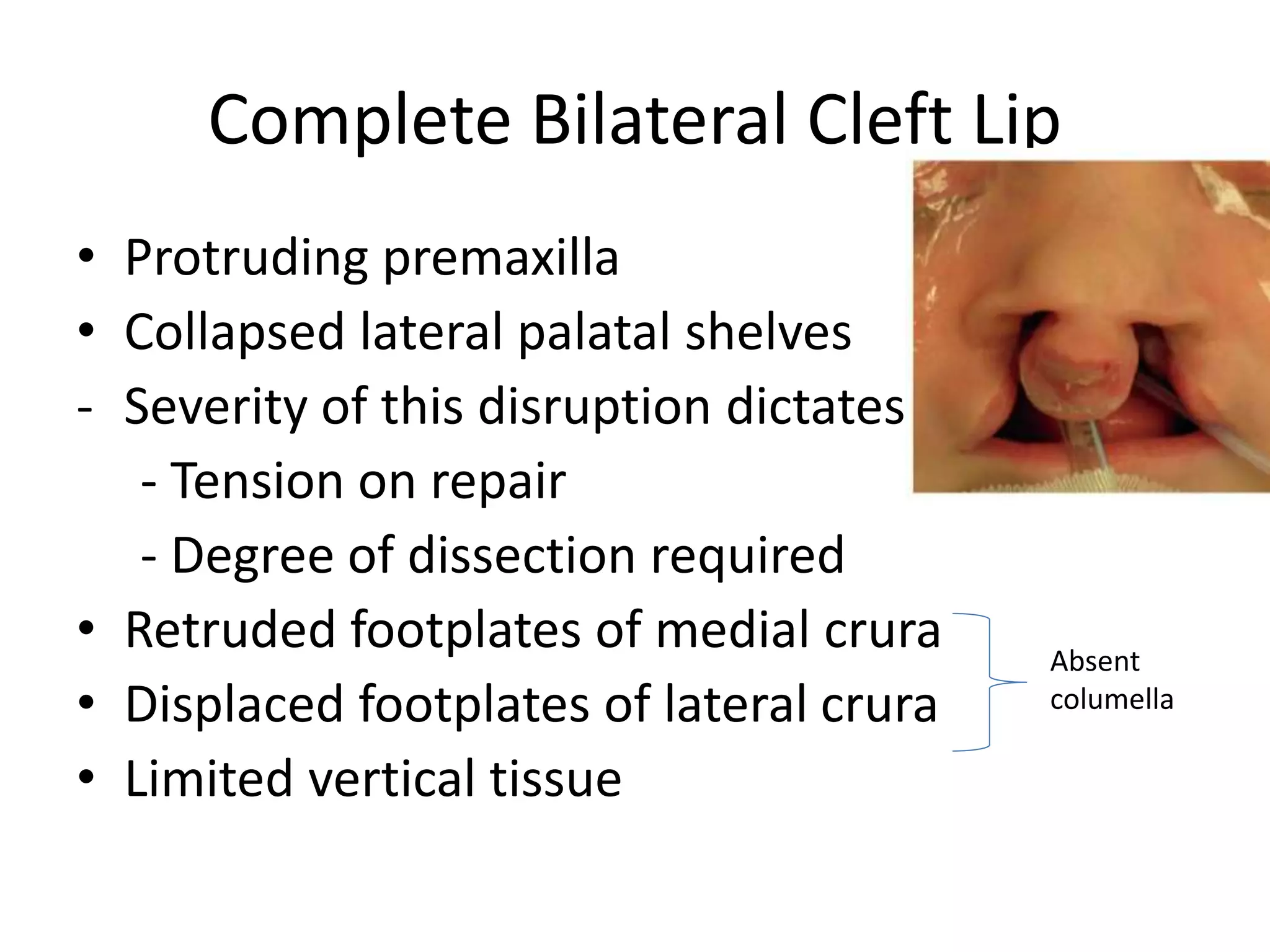 Cleft lip bilateral | PPTX