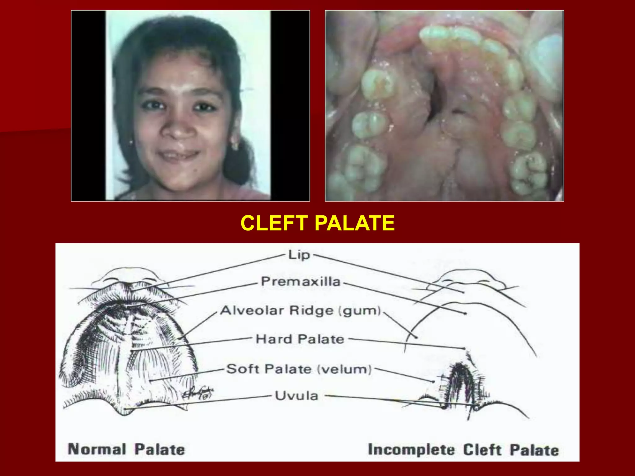 Cleft Lip & Palate | PPT