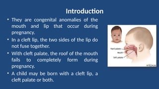 Cleft Lip and Cleft Palate - an Overview and Management | PPTX