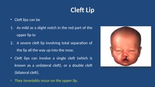 Cleft Lip and Cleft Palate - an Overview and Management | PPTX