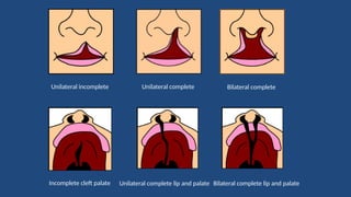 Cleft Lip and Cleft Palate - an Overview and Management | PPTX