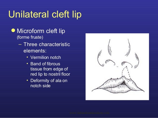 Cleft lip primary & secondary deformities /certified fixed orthodonti…