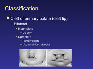 Cleft Lip-Primary & Secondary Deformities.ppt