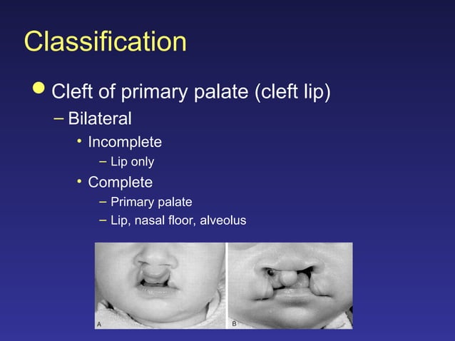 Cleft Lip-Primary & Secondary Deformities.ppt