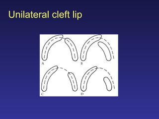 Cleft Lip-Primary & Secondary Deformities.ppt