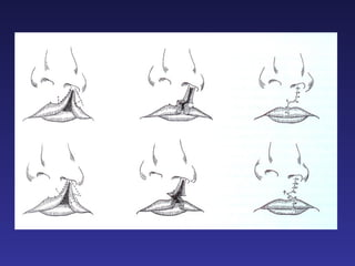 Cleft Lip-Primary & Secondary Deformities.ppt