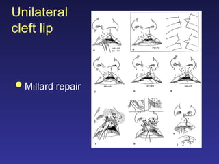 Cleft Lip-Primary & Secondary Deformities.ppt