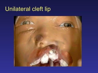 Cleft Lip-Primary & Secondary Deformities.ppt