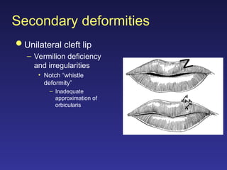 Cleft Lip-Primary & Secondary Deformities.ppt