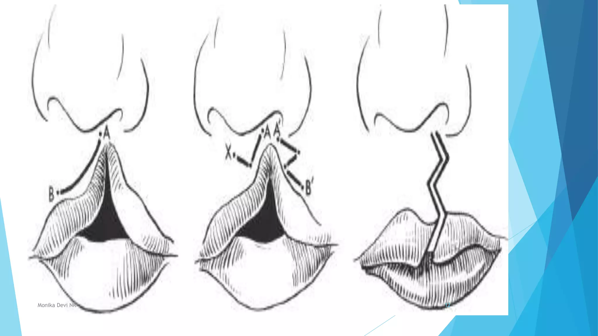 CLIFT LIP AND CLEFT PALATE | PPTX