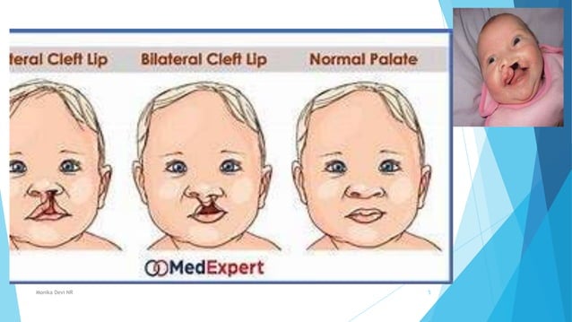 CLIFT LIP AND CLEFT PALATE | PPTX | Ear, Nose and Throat Conditions | Diseases and Conditions