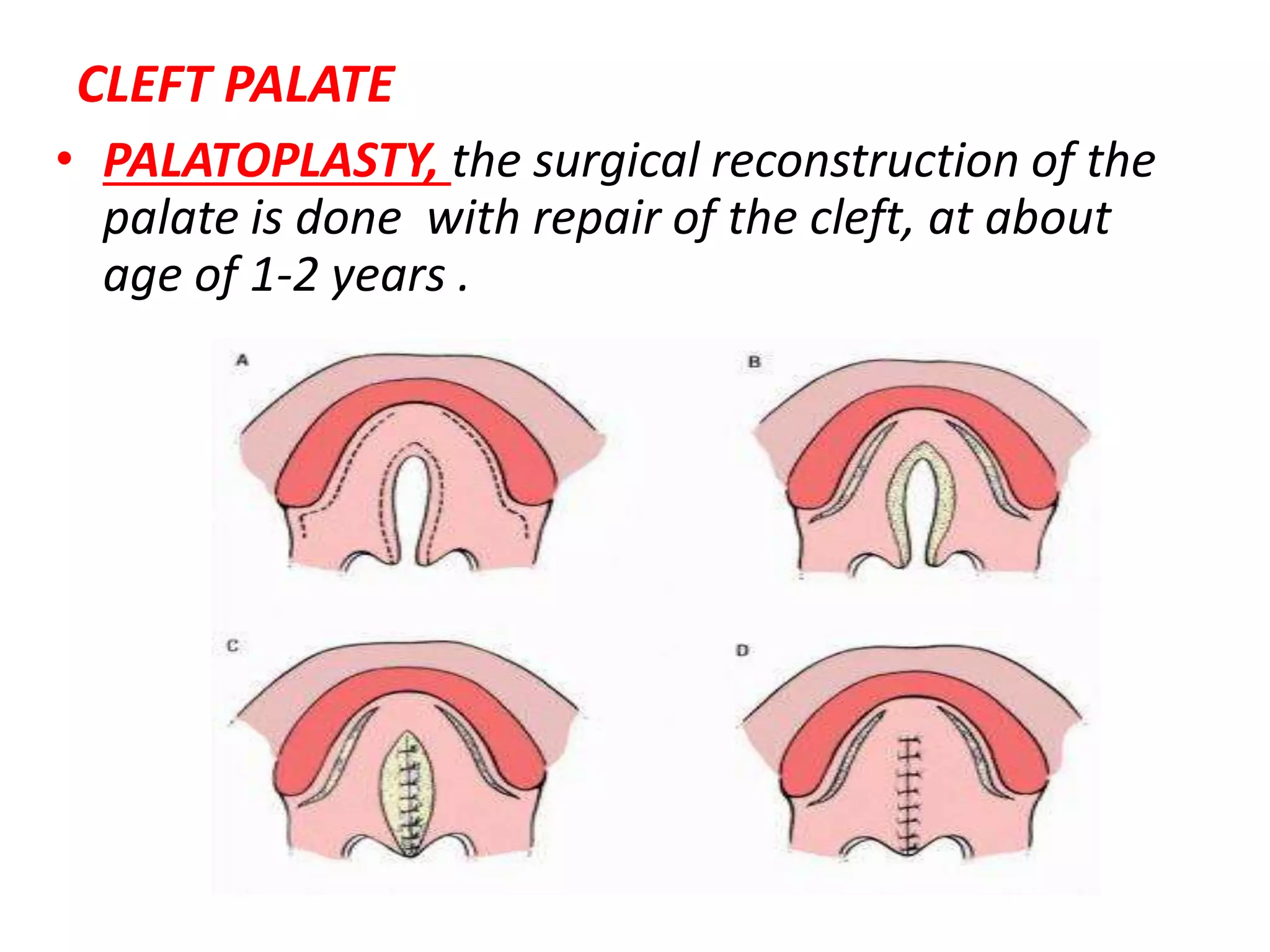 Cleft lip and cleft palate | PPTX