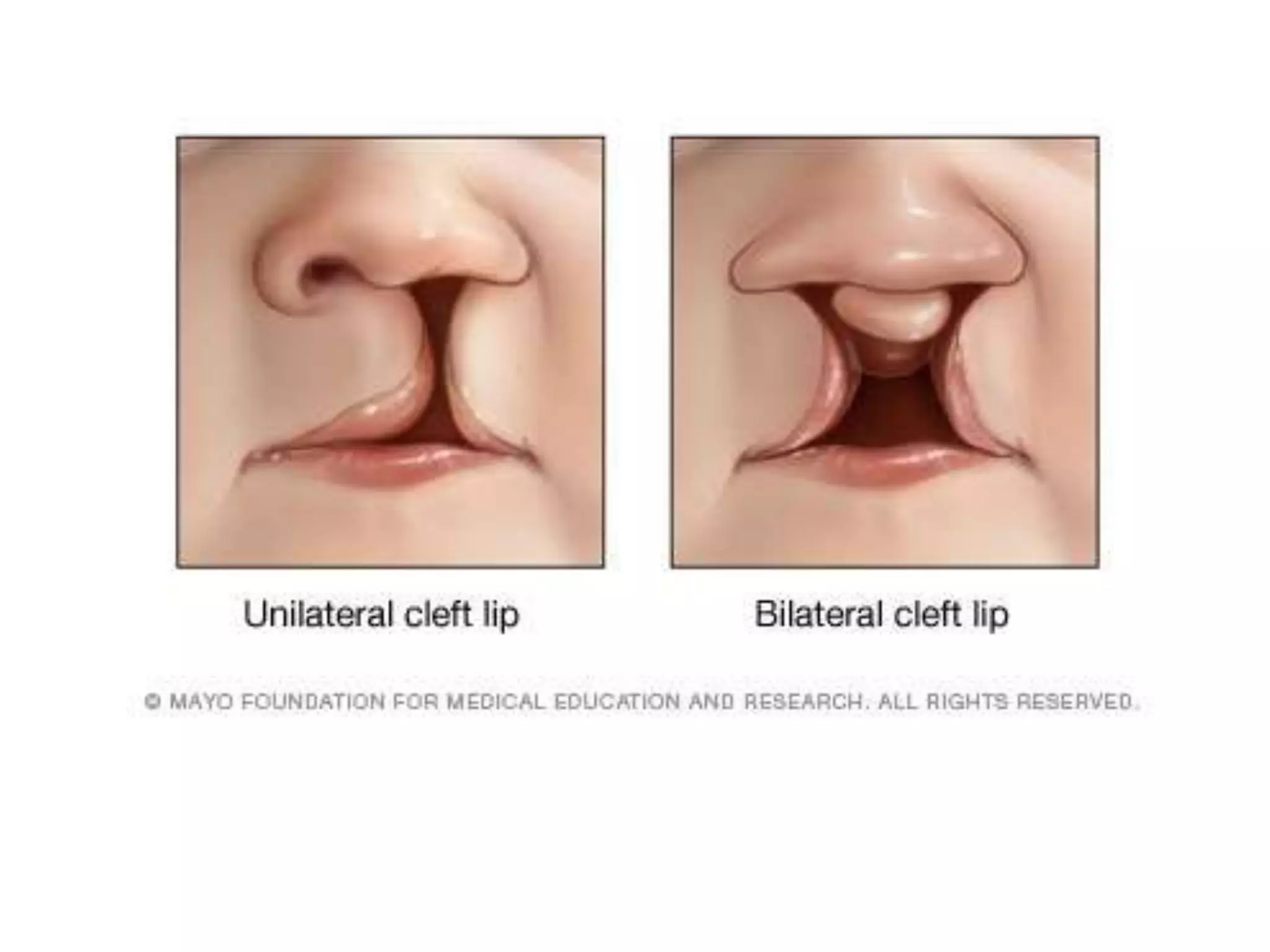 Cleft lip and cleft palate | PPTX
