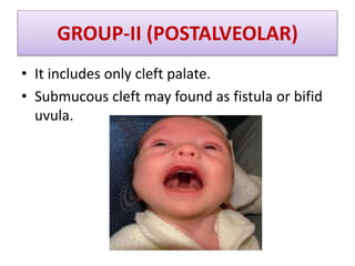 Cleft lip and cleft palate | PPTX